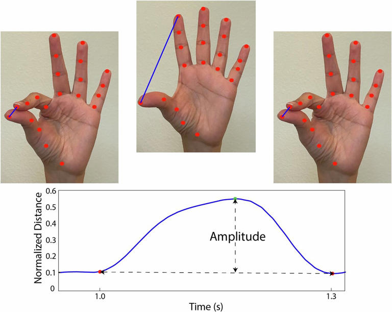 AI detects subtle movement changes in finger-tapping videos, revealing ...