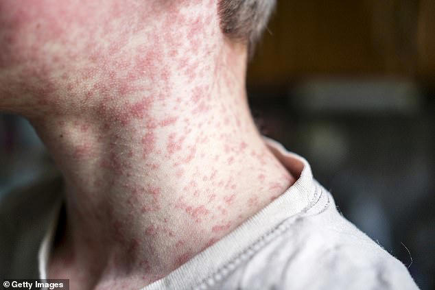 Thousands of people exposed to measles at major sporting event as ...