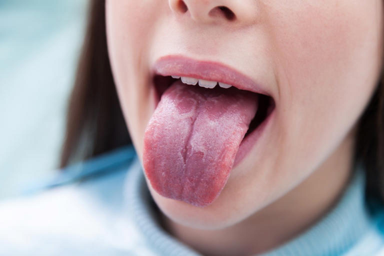What is ‘geographic tongue’? All about ‘SNL’ star Kate McKinnon’s ...