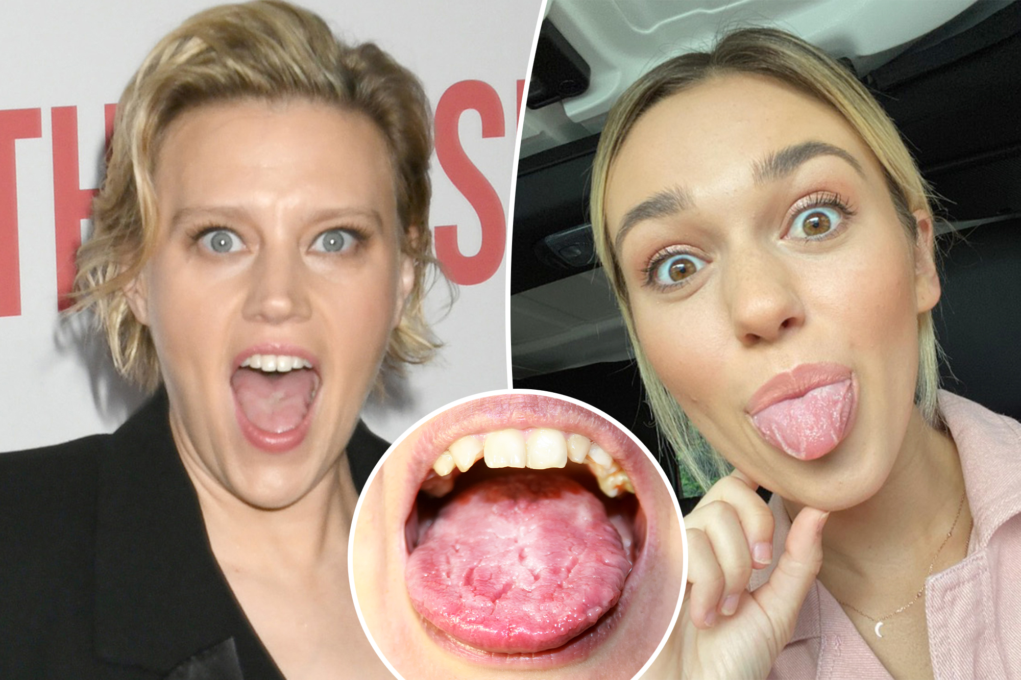 What is ‘geographic tongue’? All about ‘SNL’ star Kate McKinnon’s ...