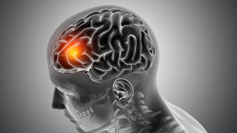 Whooshing In The Ear: Can It Be Brain Tumour?