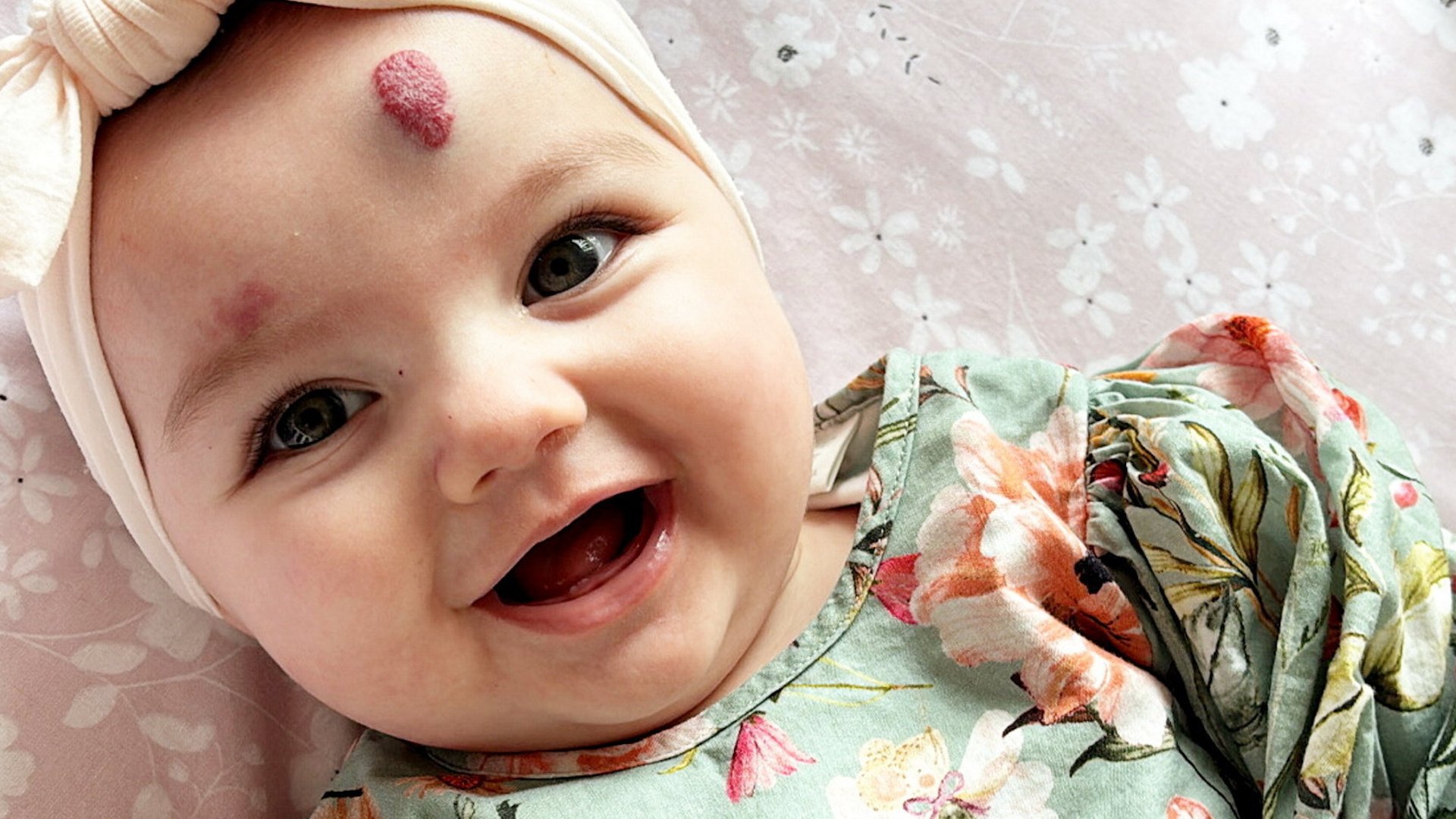 "Strangers mistook my child's strawberry birthmark for a bumped head"