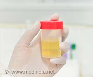 Early Prostate Cancer Detection Now Possible With a Simple Urine Test