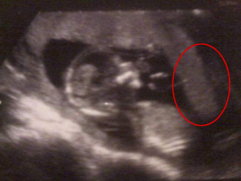 “I discovered I had two wombs while pregnant – it should have been ...