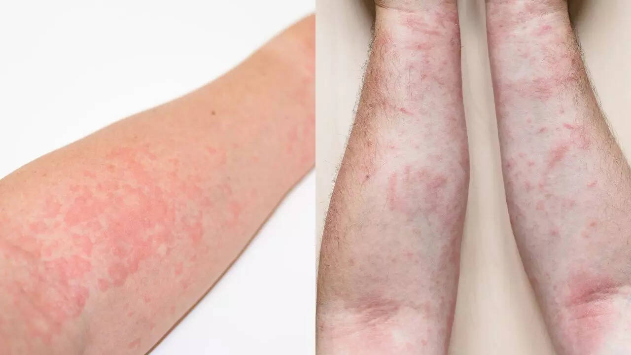 Hives vs rashes: Spot the signs, understand causes, and tips to manage ...