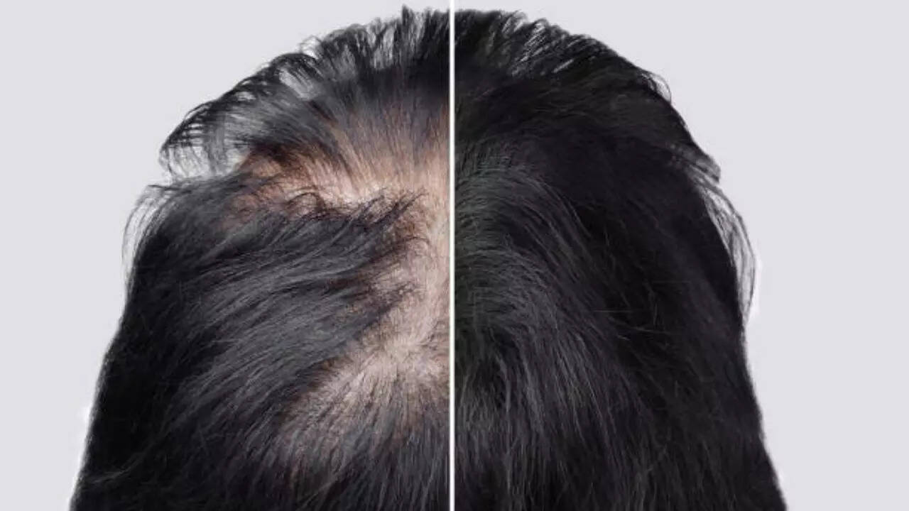 5 ingredients to mix with Mustard Oil for instant hair regrowth on bald ...
