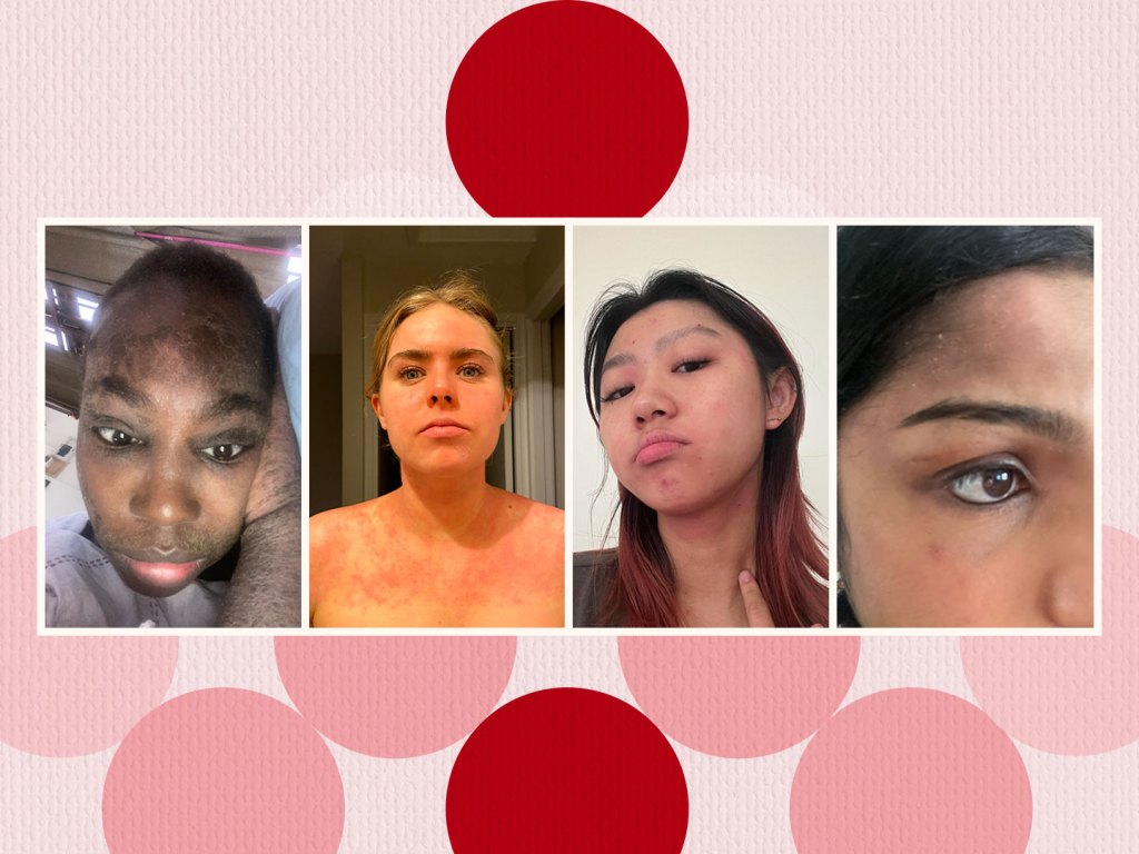 What Does Eczema Actually Look Like? 18 Photos That Show How Eczema ...