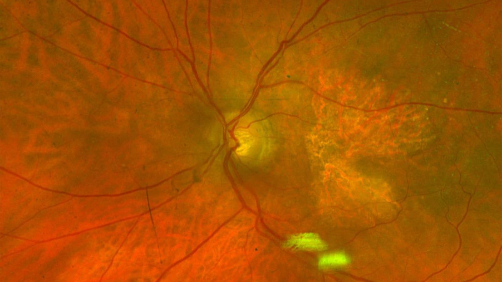 What to Do With Age-Related Macular Degeneration Plus Geographic Atrophy