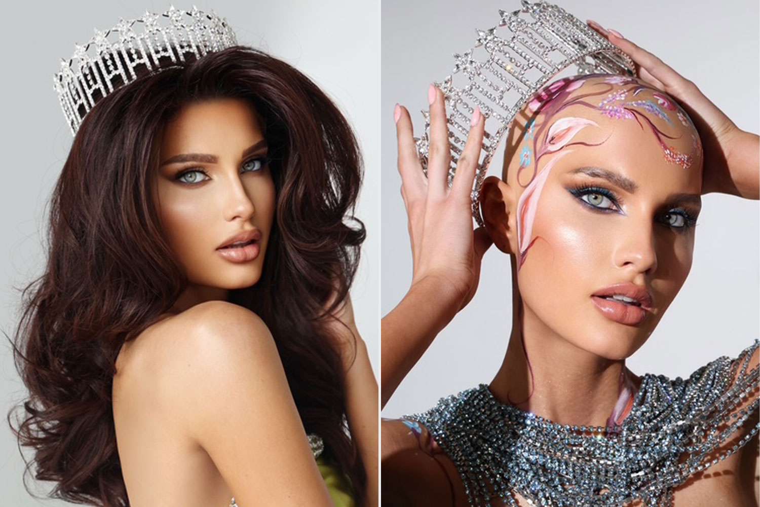 Pageant Queen's Alopecia Diagnosis Strips Her of Everything. 1 Year ...