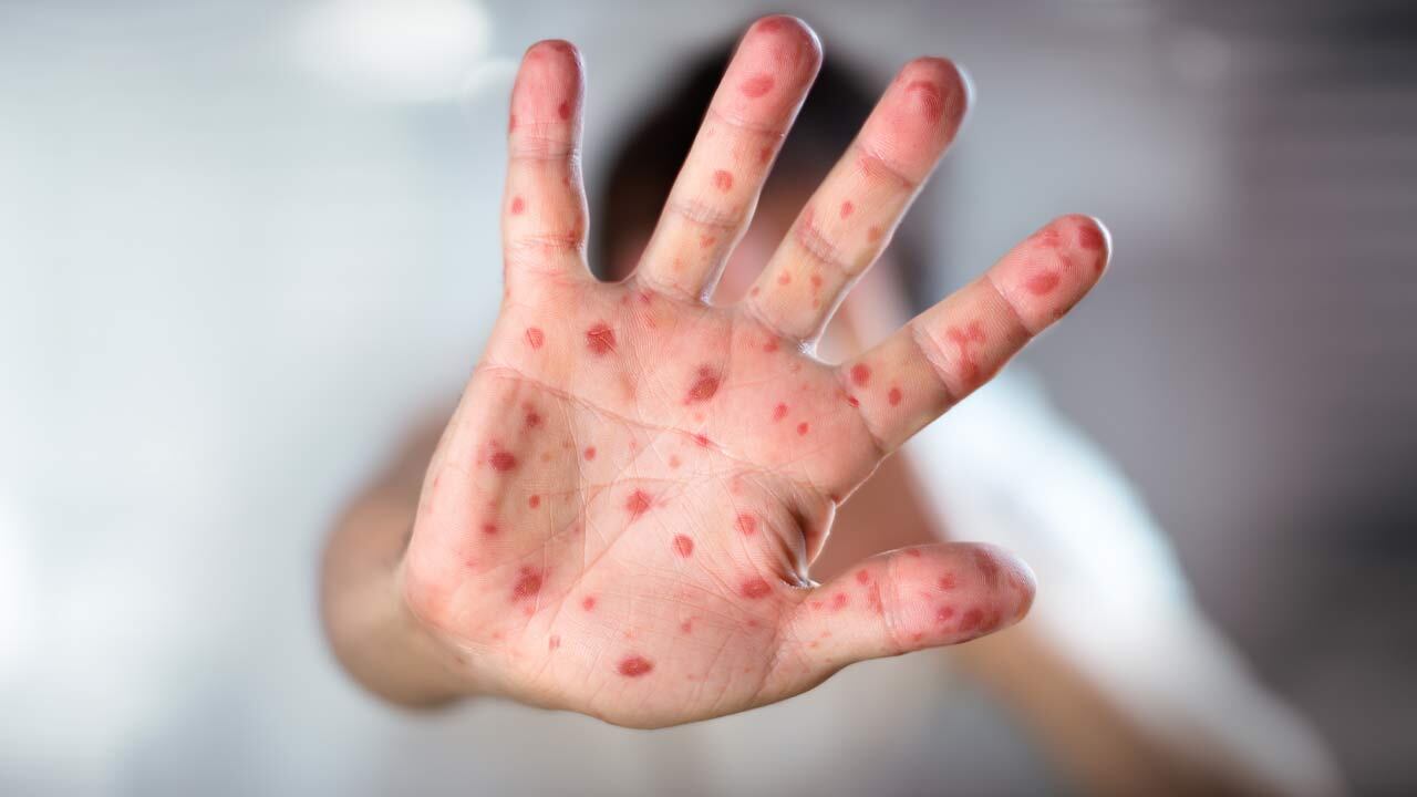 Measles confirmed in an unvaccinated Georgia resident with no ...