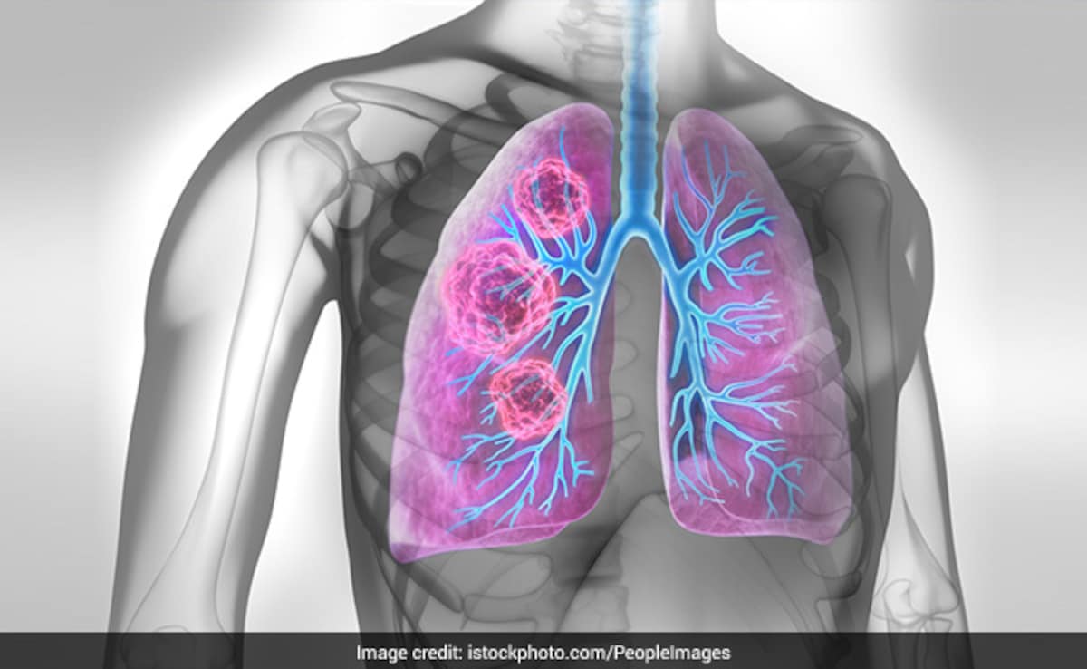 Lung cancer symptoms: 6 unusual signs of the deadly disease you should know