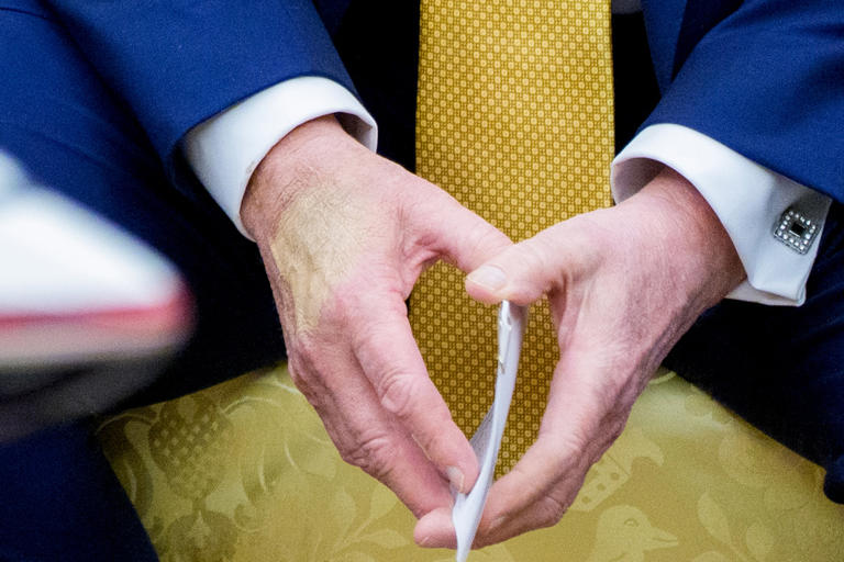 On Trump’s hand, it’s not just the bruise. It’s the (apparent) cover-up.