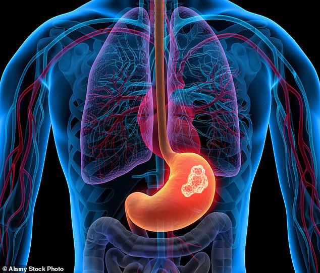 Heartburn warning: Top GP reveals red-flag symptoms that could signal ...