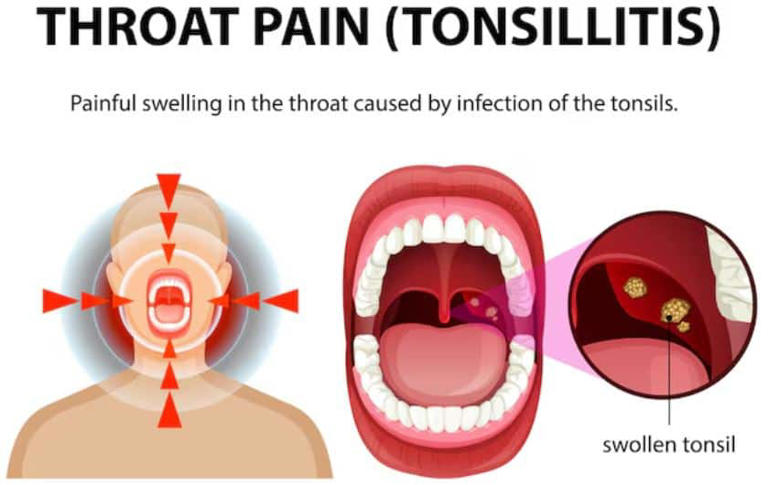 What Are Tonsil Stones? How To Prevent, Remove, And Heal Them - Dos And ...