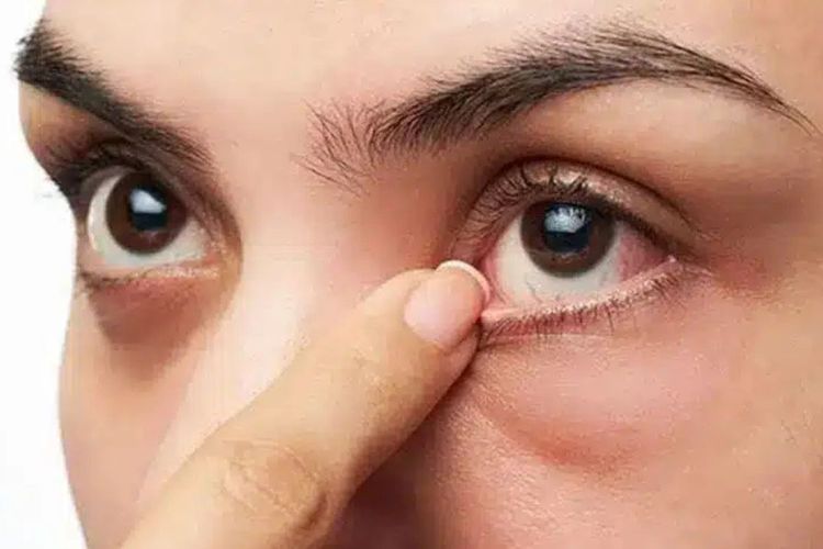 Cara Menghilangkan Mata Sembab Secara Alami, Bikin Wajah Kembali Segar