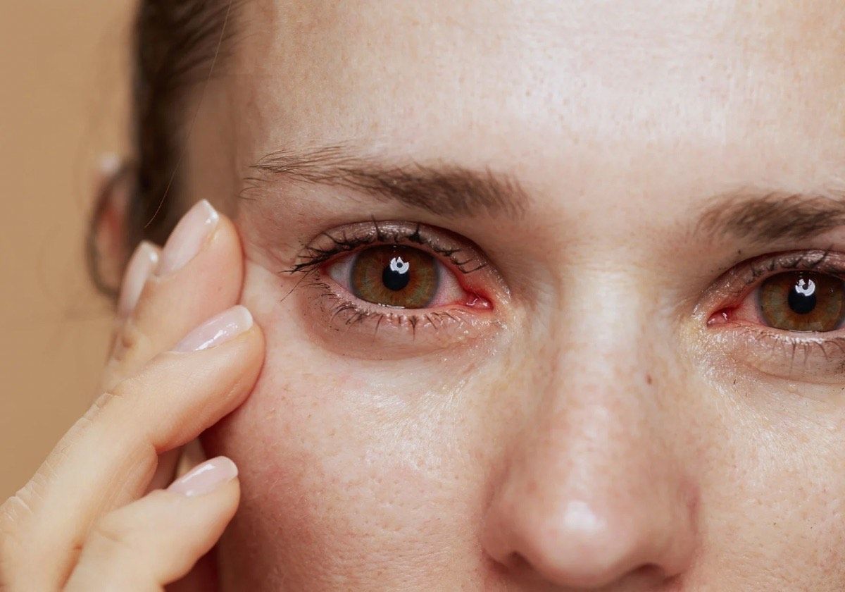 Waspadai! Ini Penyebab Mata Merah dan Cara Mengatasinya Menurut Dokter