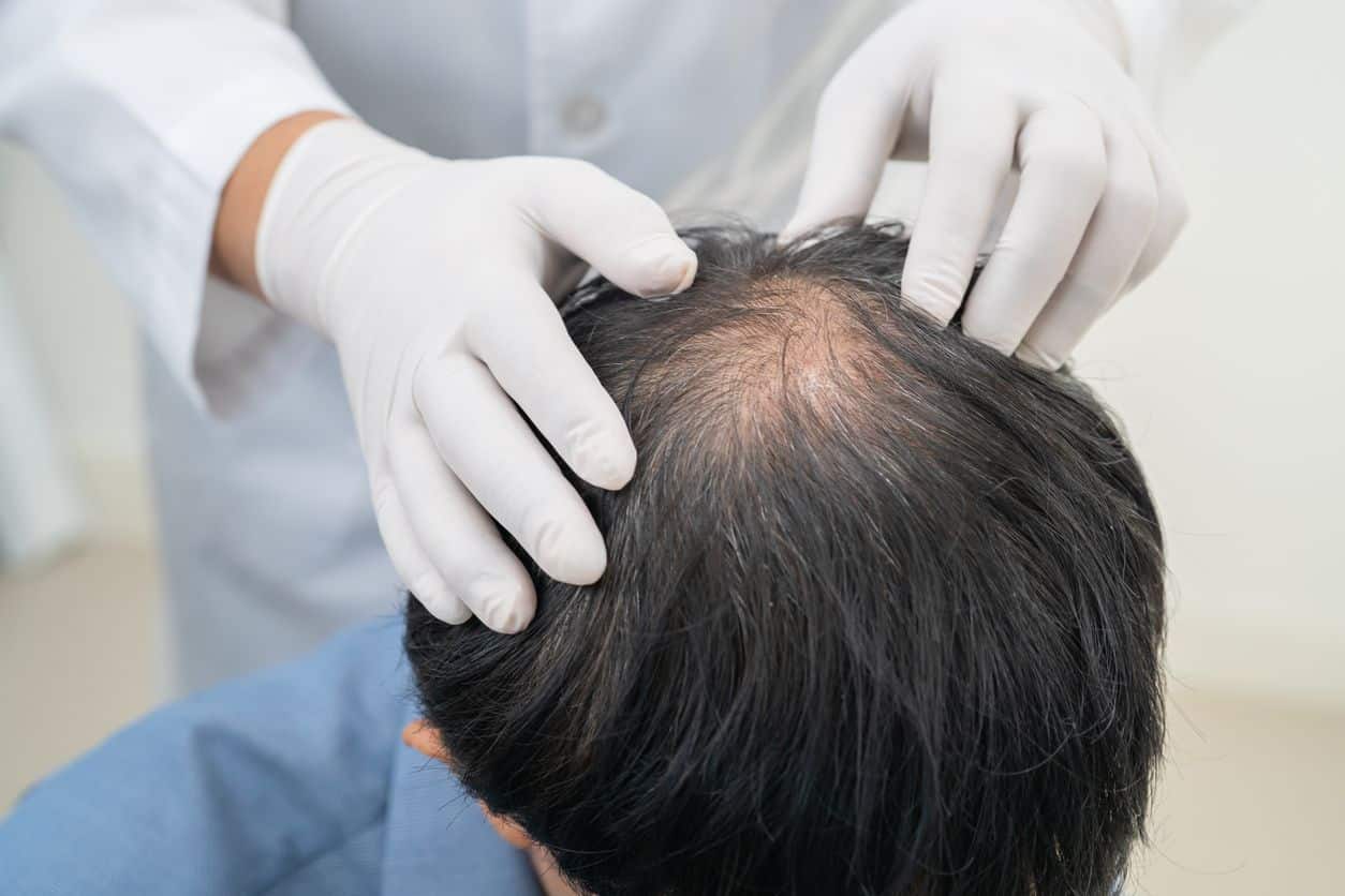 How to stop your dry scalp from causing hair loss