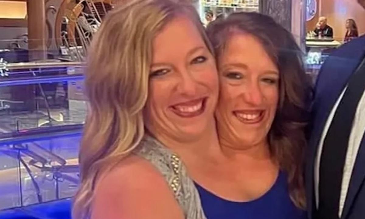 What Happens When One Conjoined Twin Dies? Here’s What Science Says