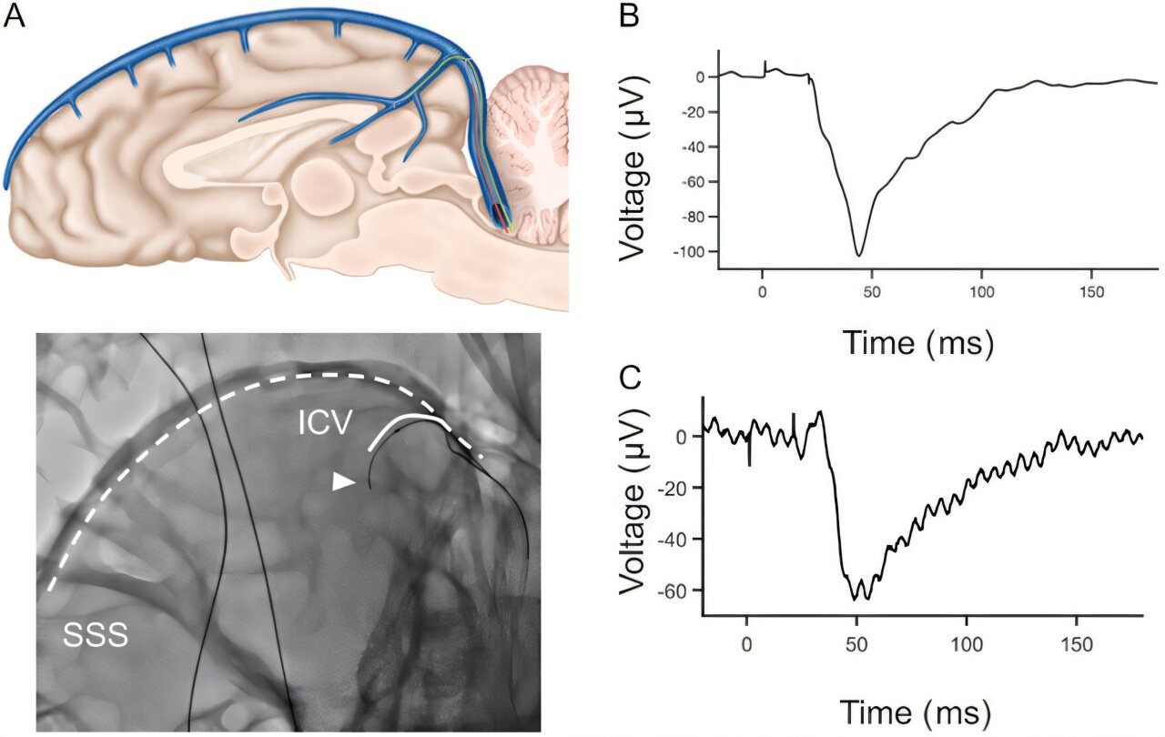 Less invasive brainwave recording uses blood vessels to access activity ...
