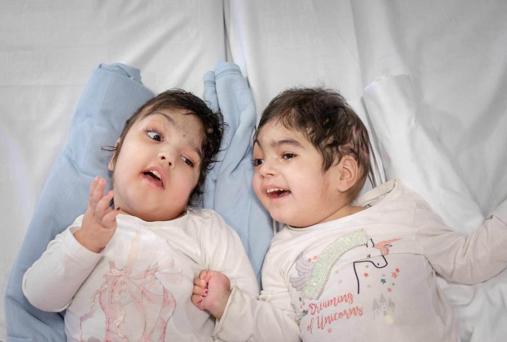 What Happens When One Conjoined Twin Dies? Here’s What Science Says