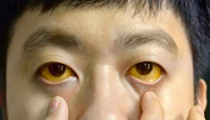 5 Major Causes Of Jaundice In Adults And Children You Should Never ...