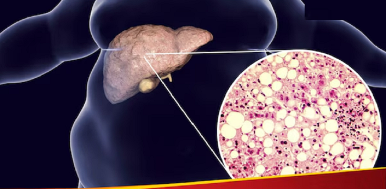 Fatty liver is a silent killer! This is how it silently causes harm ...