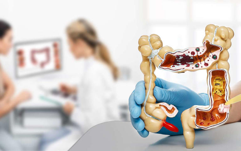 Ce nutriment bien connu pourrait réduire le risque de cancer du côlon ...