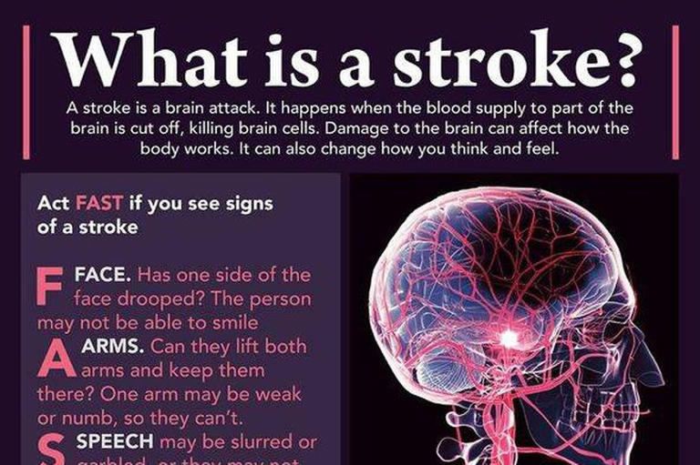 One warning sign of a stroke that can appear up to a week before it happens