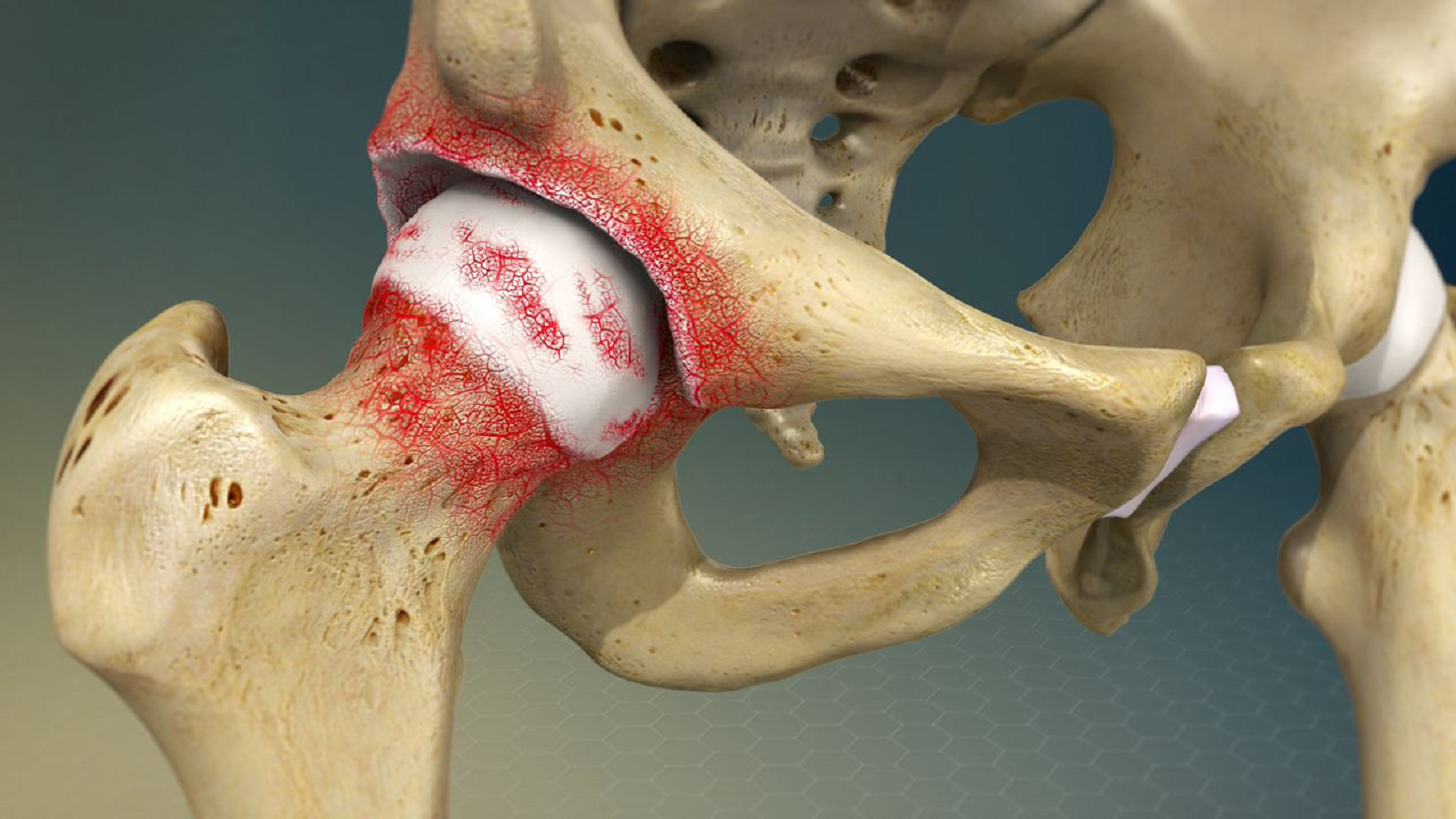 Increasing Hip Bone Weakness: Causes and Prevention Tips