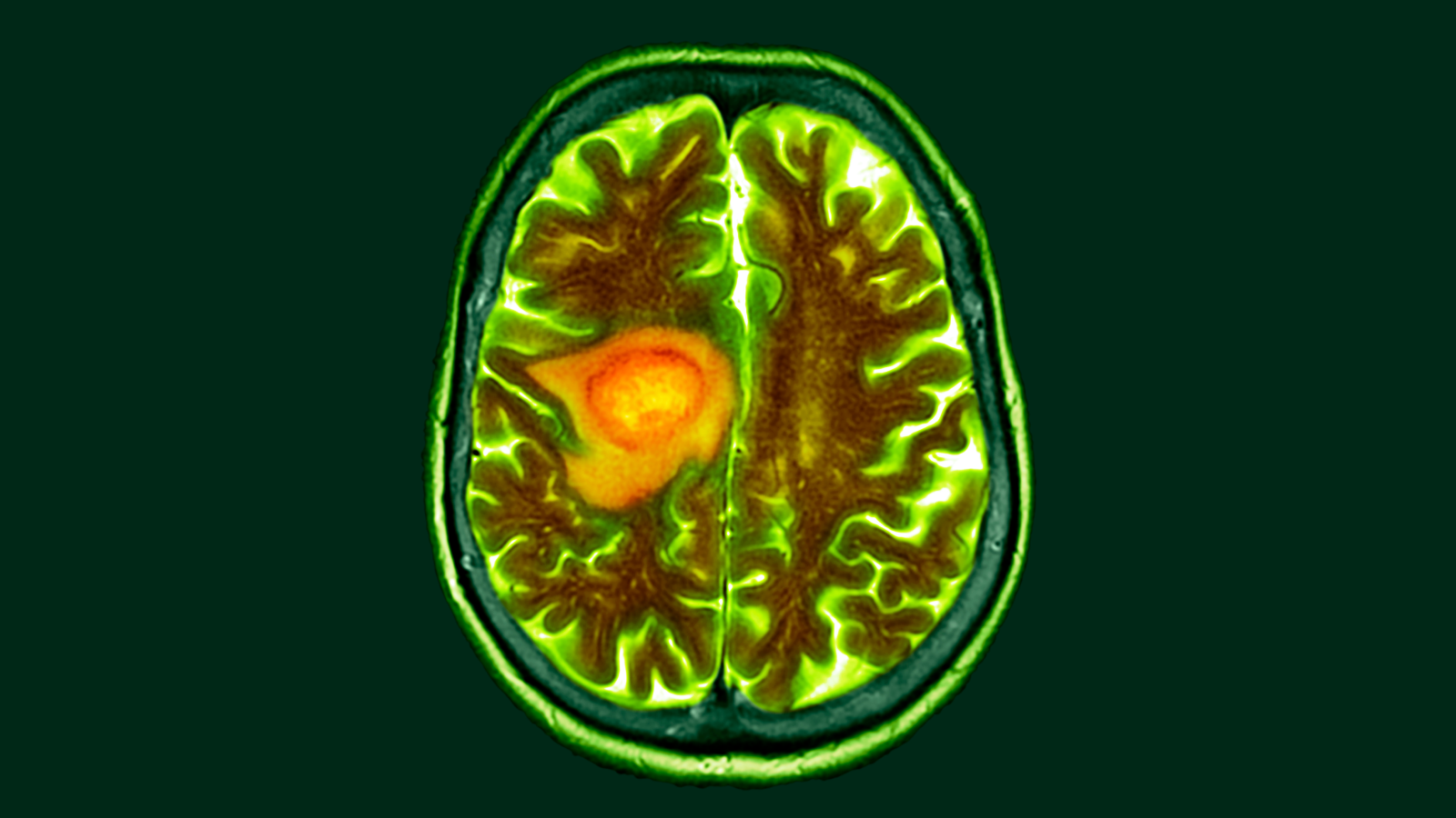 🍽️ A simple dietary modification to fight brain cancer?