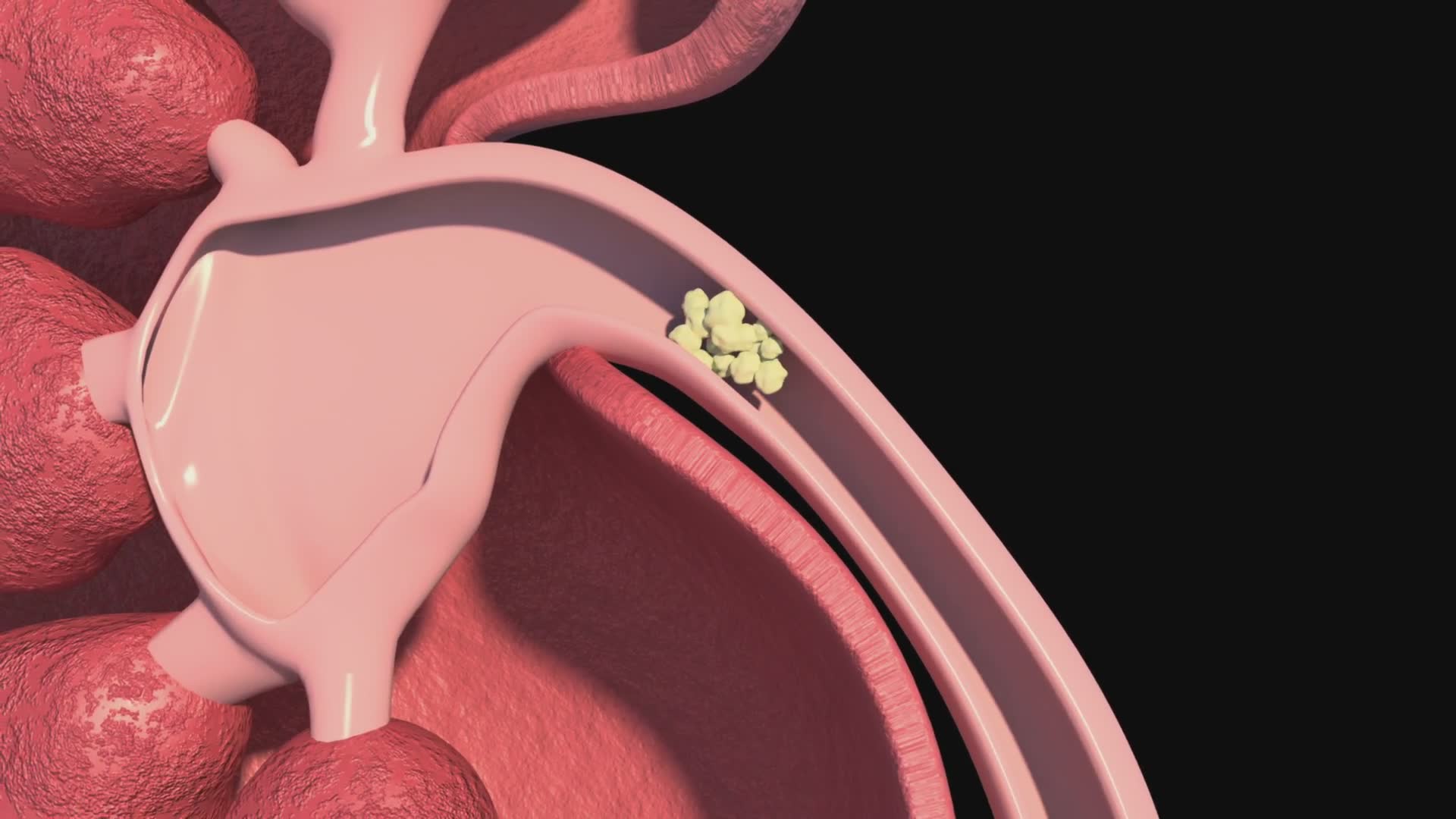 Mineral deposit formation and removal