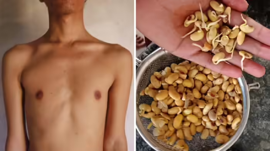 Is your body losing flesh, leaving only bones? Eat these 10 things as ...