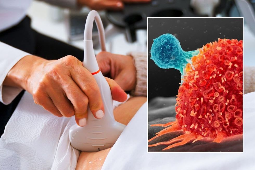 Colon cancer warning: The foods rocketing your risk of the disease by ...