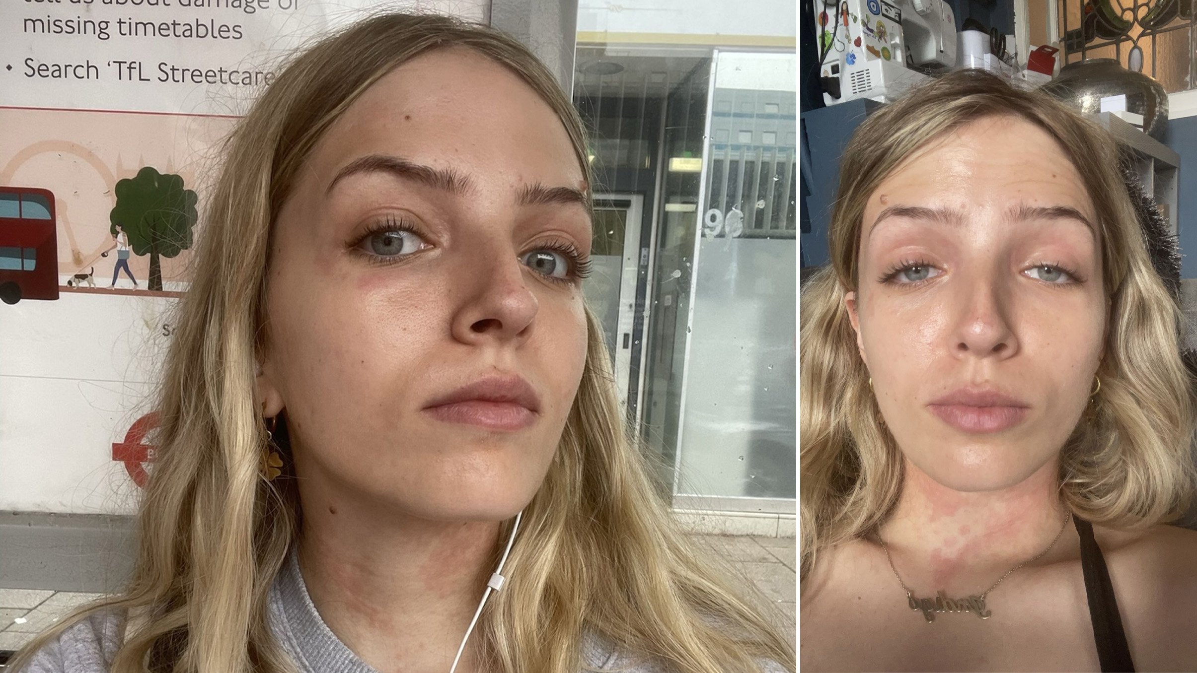 Woman catches Victorian disease after gig in Brixton