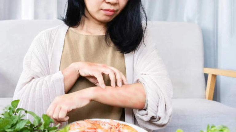 Five Surprising Foods That Can Trigger Severe Allergic Reactions