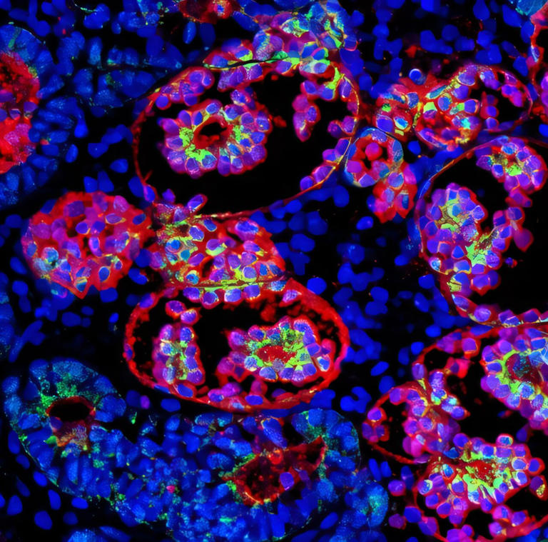 Kidney organoids reveal how APOL1 mutations affect mitochondrial ...