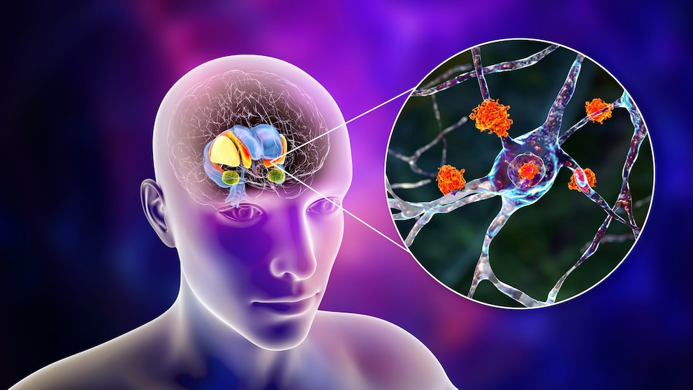 Chorea Huntington: Symptoms of the Rare Brain Disorder