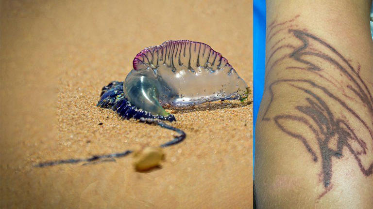 How to Survive a Portuguese Man O’ War