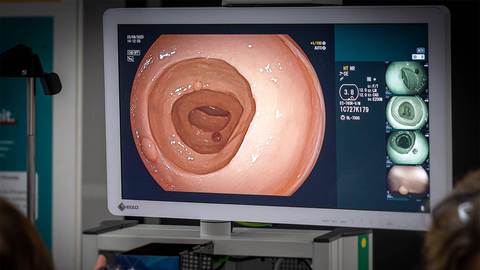 What Constitutes 'Cure' in Colon Cancer? Researchers Propose a New ...