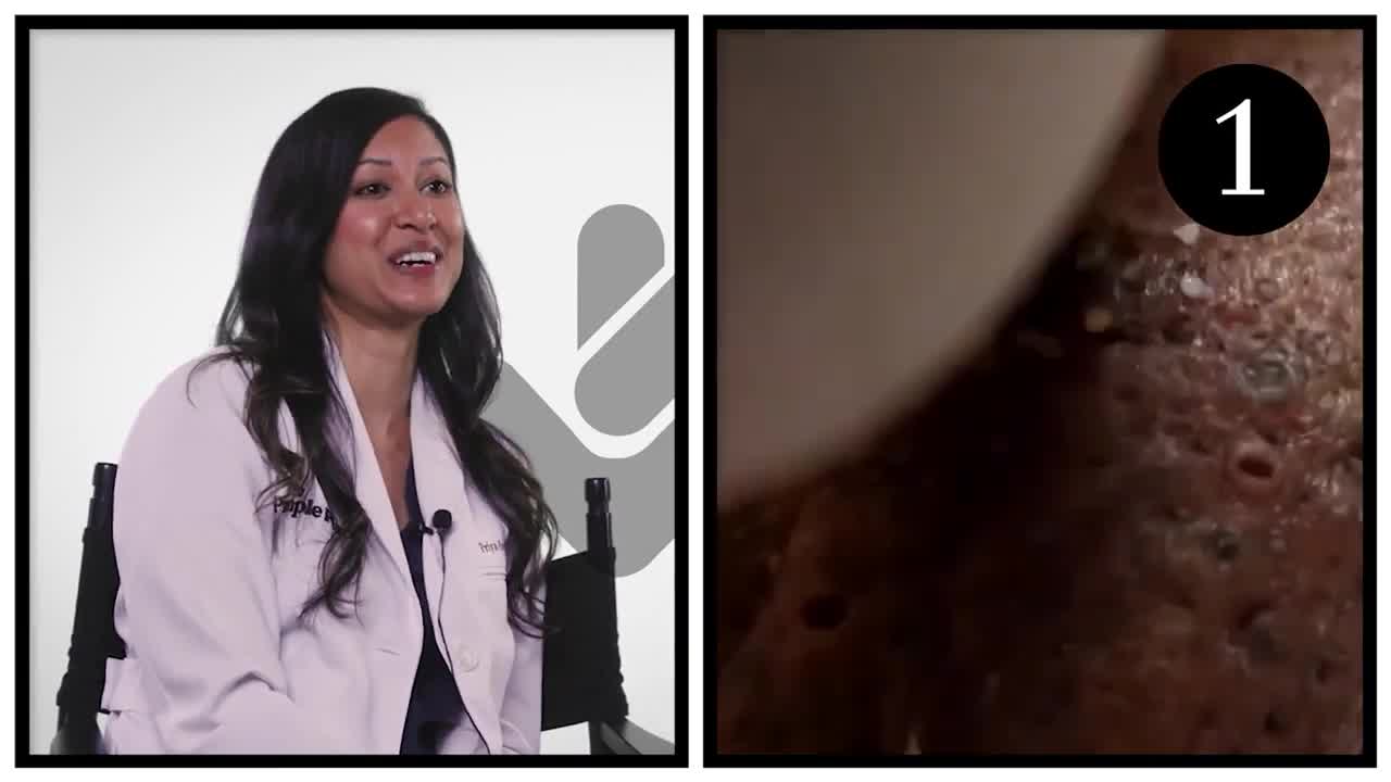Professional Blackhead Remover ReRanks The Most Satisfying Blackhead ...