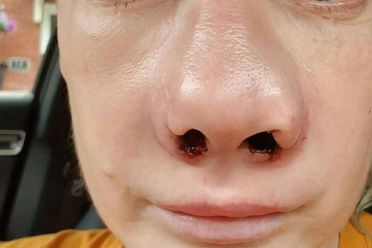 Turkey teeth nightmare as mum's nose ruined after 'jigsaw pearly whites'