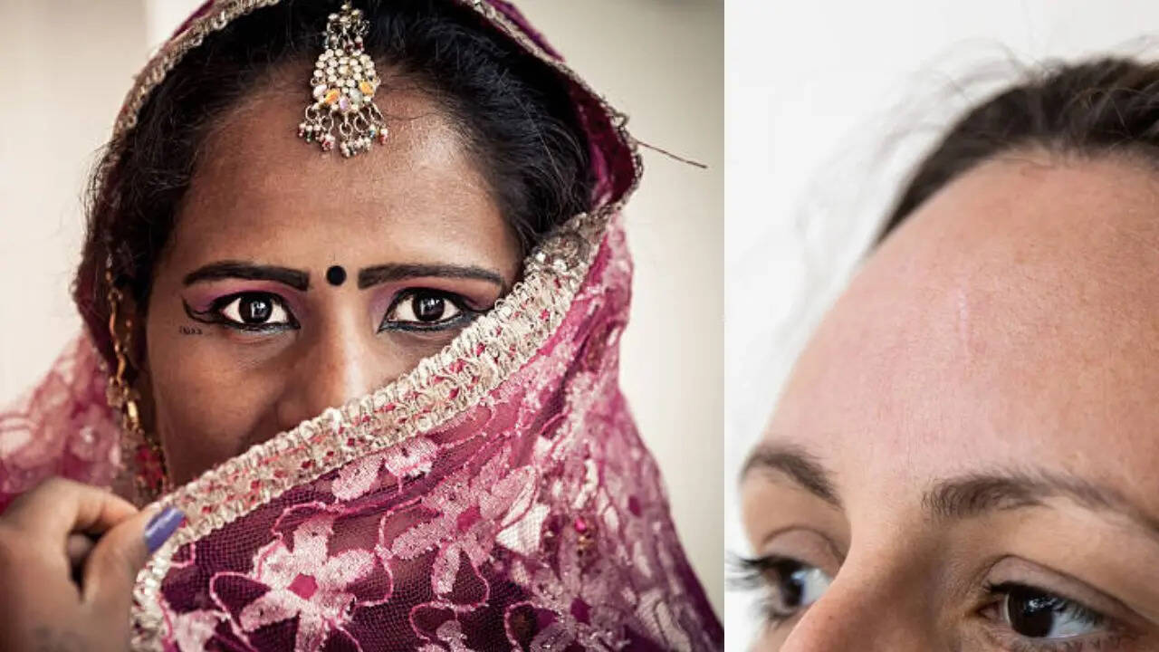Beware of Bindi Leukoderma, As Adhesive Chemicals May Harm Your Skin