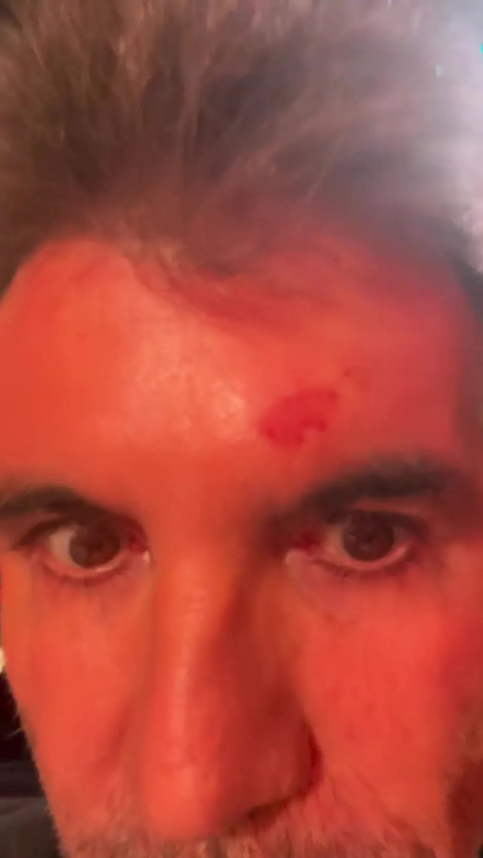 Simon Cowell skips BGT after shocking head injury