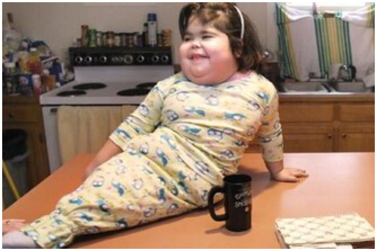 Kenali Mermaid Syndrome, Kondisi Langka dengan Risiko Tinggi pada Bayi ...