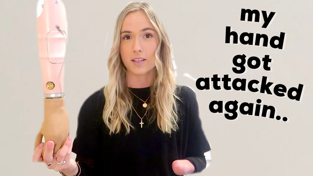 Amputees' Final 24 Hours with Hands: My Hand Was ATTACKED!