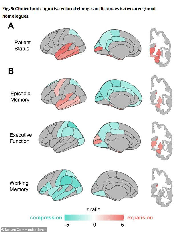 The shape of your brain could predict if you will develop dementia ...