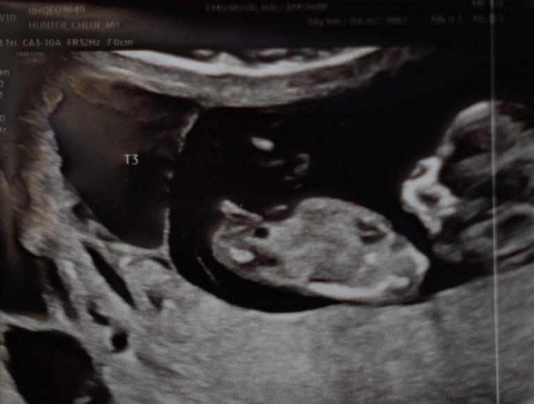 Woman who thought she was perimenopausal discovers she’s pregnant with ...