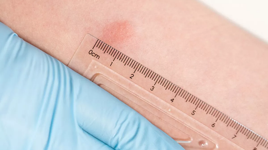 TB testing to become easier as ICMR approves indigenous kit