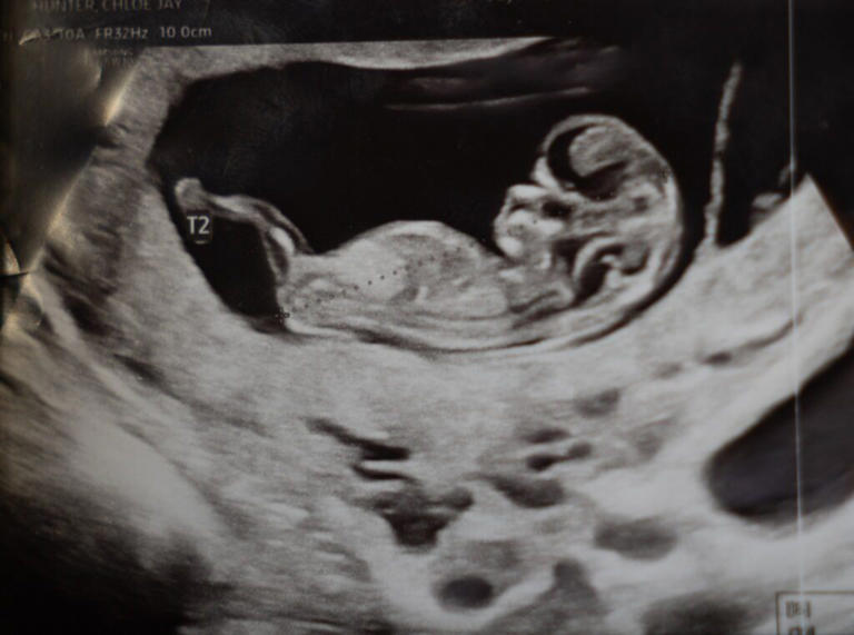 Woman who thought she was perimenopausal discovers she’s pregnant with ...