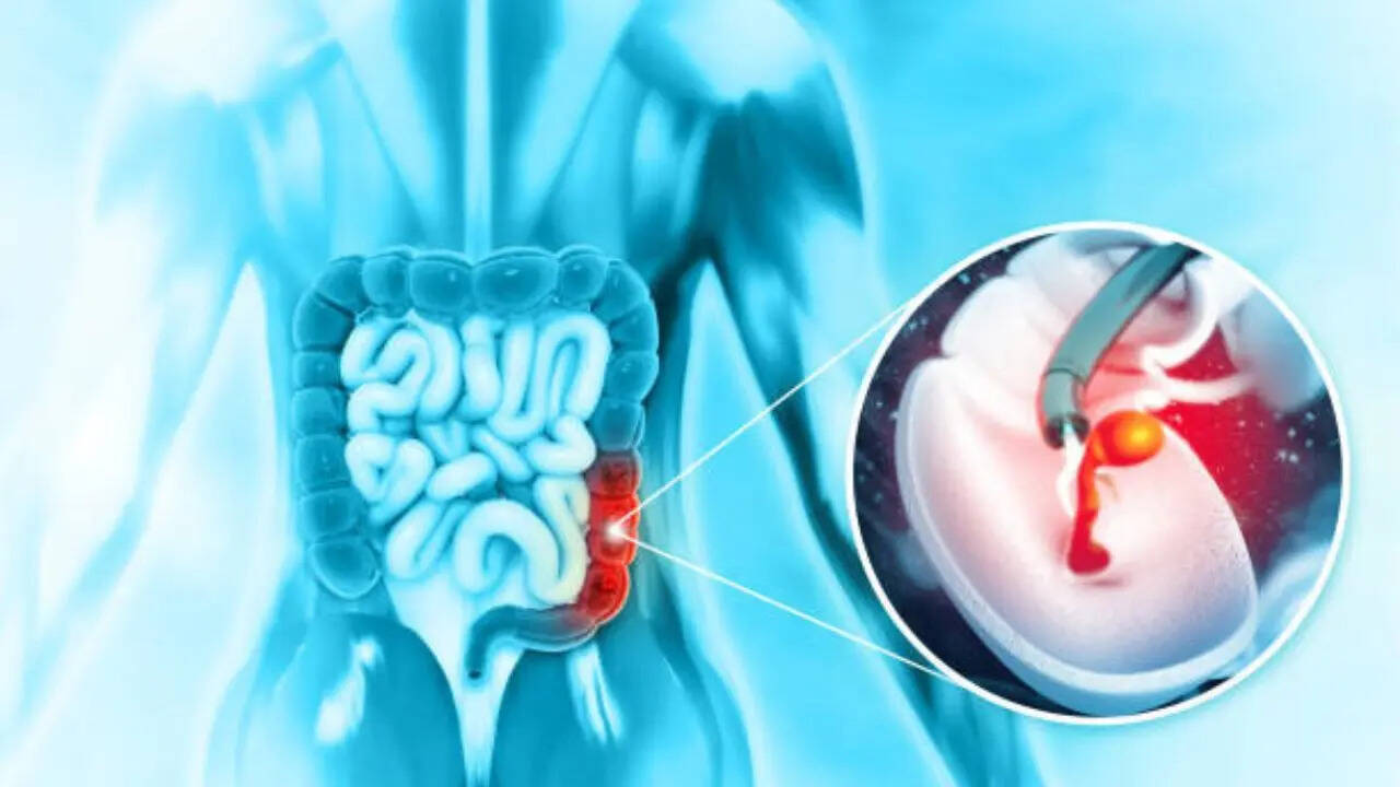 One Simple Test for Colon Cancer Can Save Your Life, Says Top US Doctor